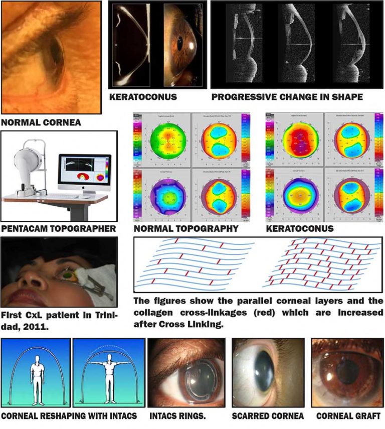 The Patient’s Guide To Keratoconus - The Voice St. Lucia News